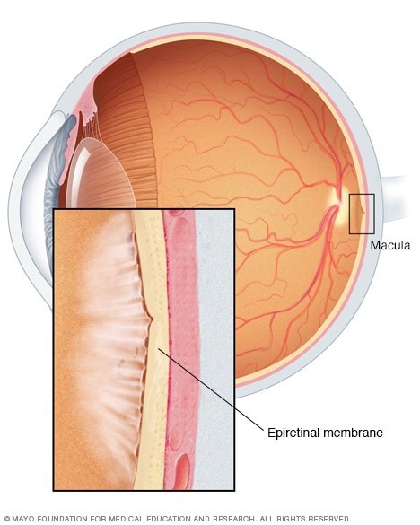 Causes of Epiretinal Membrane | Southern Vitreoretinal Associates