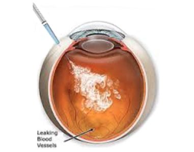 Diabetic Retinopathy | Southern Vitreoretinal Associates