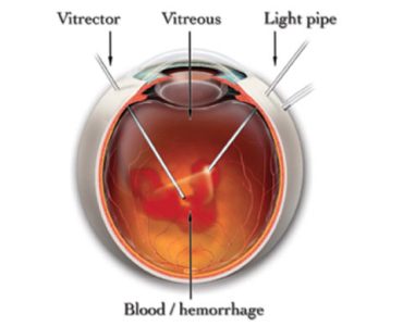 Diabetic Retinopathy | Southern Vitreoretinal Associates