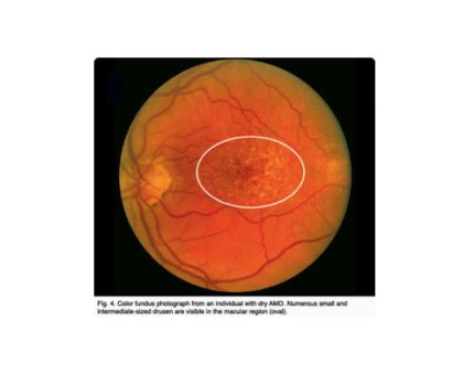 Macular Degeneration | Southern Vitreoretinal Associates