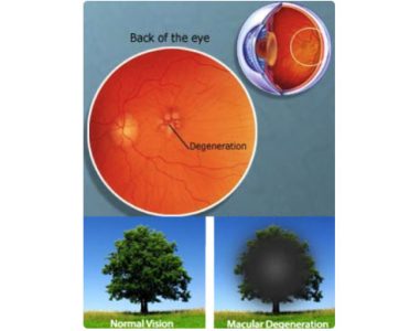 Macular Degeneration | Southern Vitreoretinal Associates
