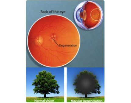 Macular Degeneration | Southern Vitreoretinal Associates